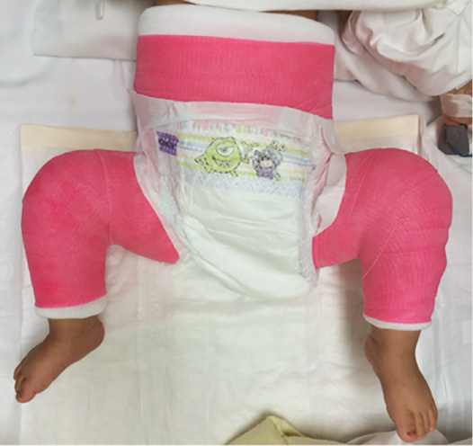 View of Closed Reduction of Developmental Dislocation of the Hip with ...