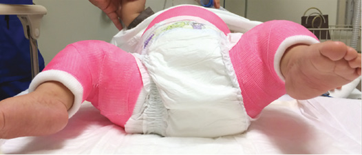 View of Closed Reduction of Developmental Dislocation of the Hip with ...