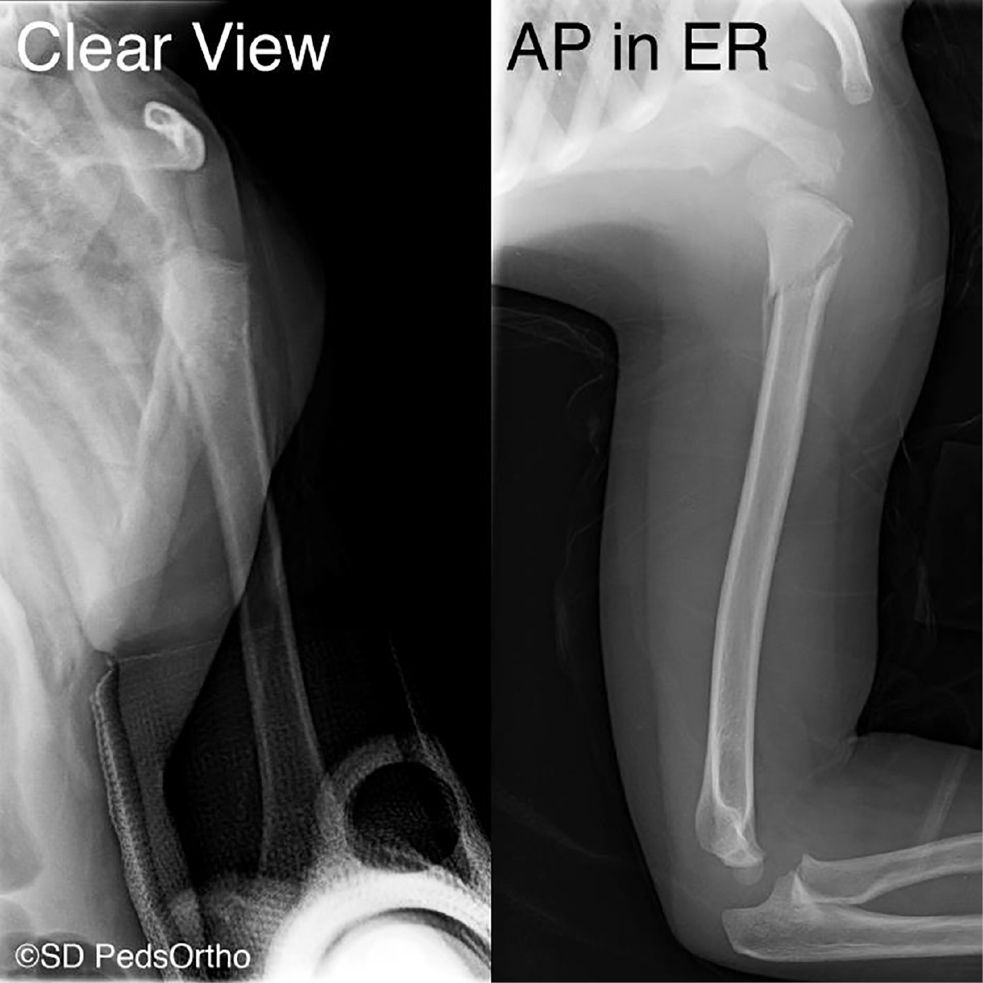 View of Validation of a Novel Radiographic View for Evaluating Proximal ...
