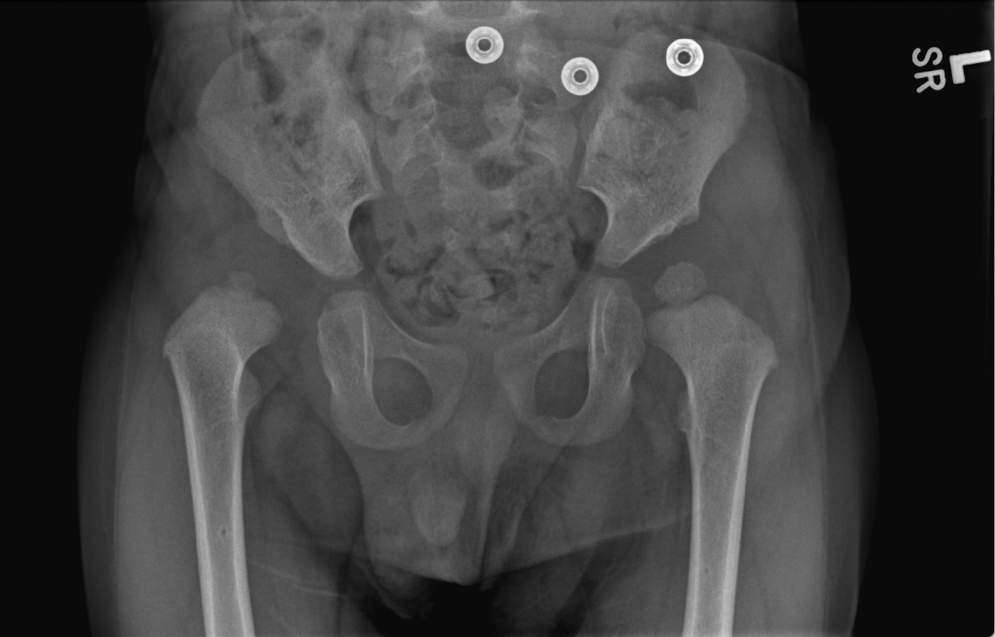 View of Proximal Femoral Growth Alterations Can Be Seen Prior to ...
